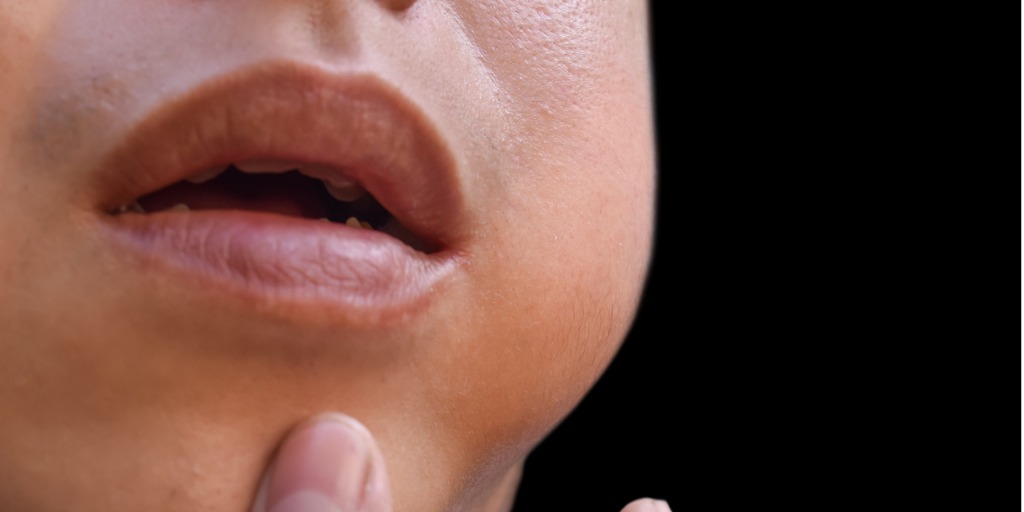 On Lymphoedema - My Facial Pain