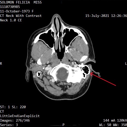 On Lymphoedema - My Facial Pain
